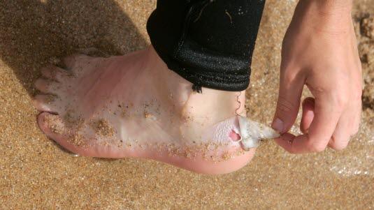 Blemmer og gnagsår - NHI.no