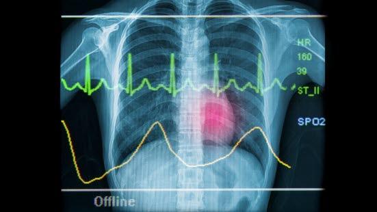 EKG ved angina og hjerteinfarkt - NHI.no