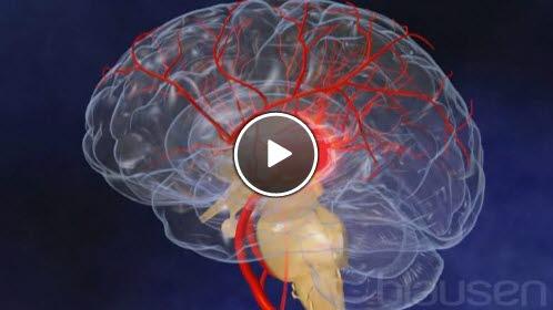 Symptomer på hjerneslag - NHI.no