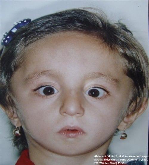 Nager syndrom - NHI.no