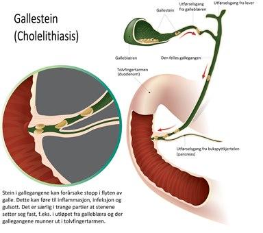 Gallesteinssykdom - Årsaker - NHI.no