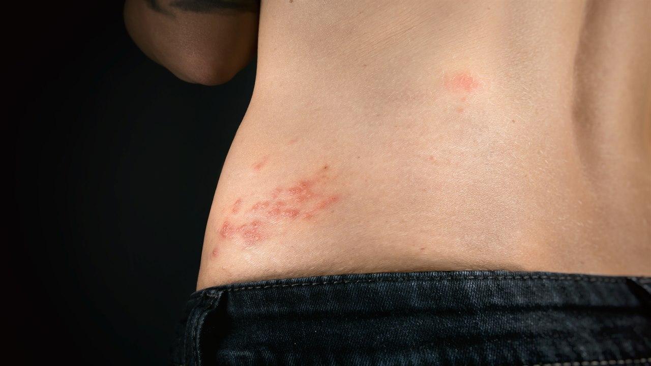 SKABB: Utslett og mistenker skabb? - NHI.no