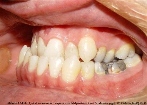 Nager syndrom - NHI.no