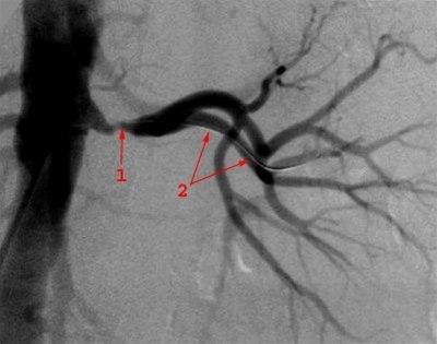 Hypertensjon, årsaker - NHI.no