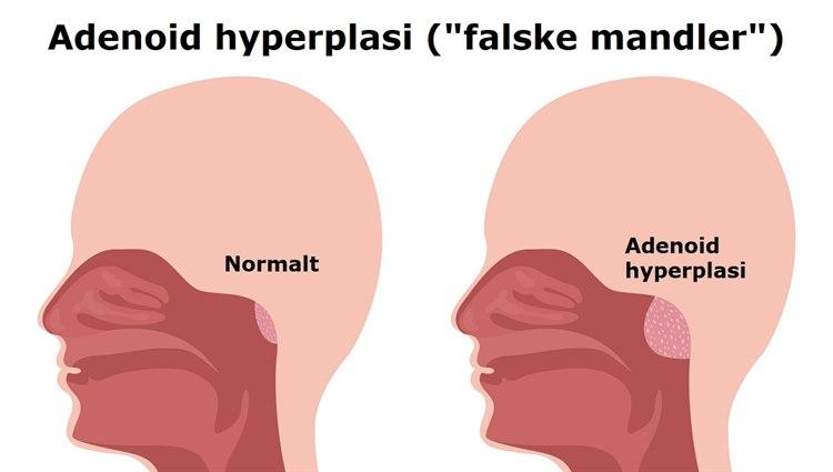 Falske mandler (adenoider) - NHI.no