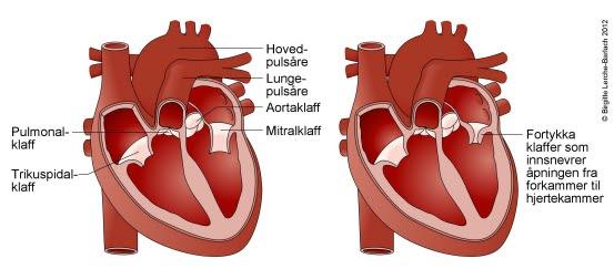 Mitralstenose - NHI.no