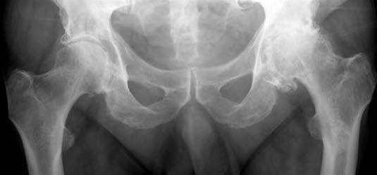 Coxartrose bilateralt - NHI.no