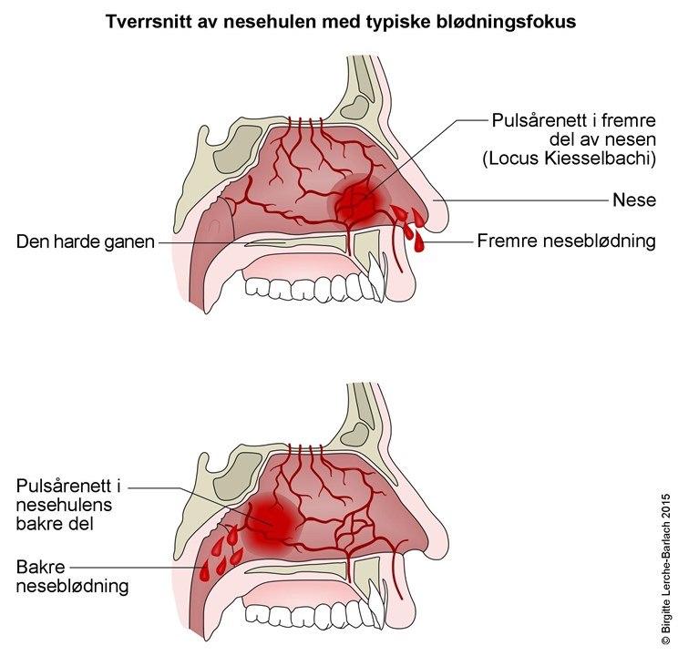 Neseblødning: Hva kan årsaken være? - NHI.no