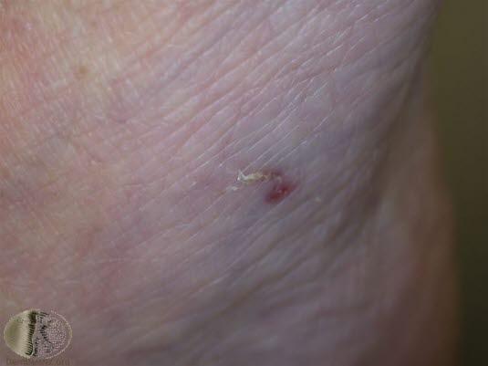 Skabb, skabbgang - NHI.no