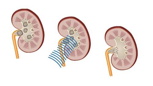 Nyrestein - Behandling - NHI.no