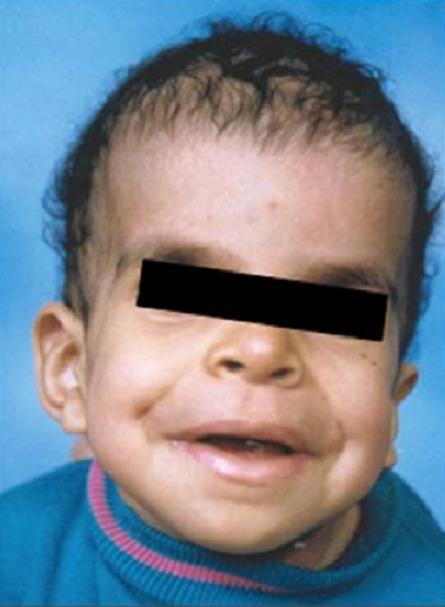 Costellos syndrom