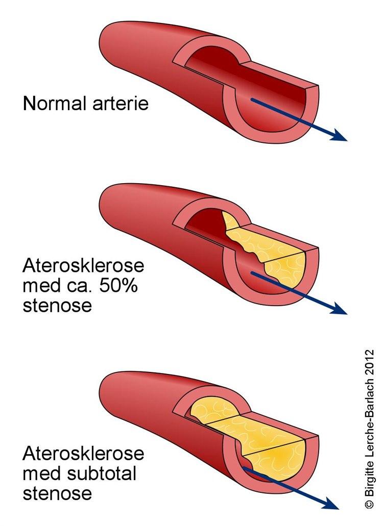 Tett pulsåre i benet, akutt - NHI.no