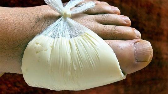 Urinsyregikt, podagra - NHI.no