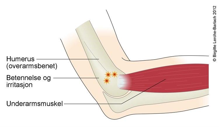 Tennisalbue og golfalbue - NHI.no