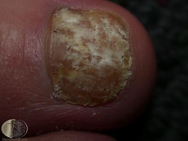Soppinfeksjon på kroppen (candidiasis) - NHI.no