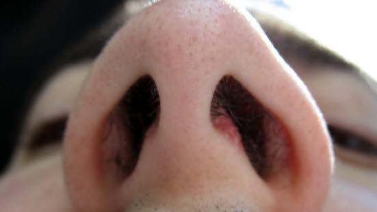 Nese- og nasofarynkskreft - NHI.no