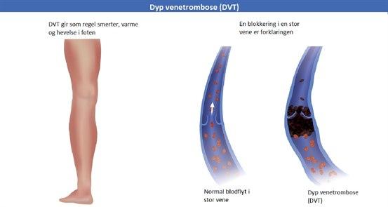Utsatt diagnostikk ved mistanke om dyp venetrombose ved å gi en ...